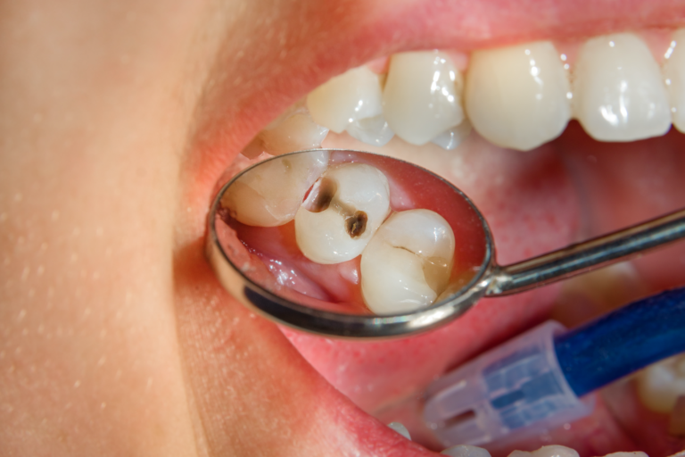 WHAT IS DENTAL CARIES? TREATMENTS, SIGNS, AND SYMPTOMS – Keith A ...