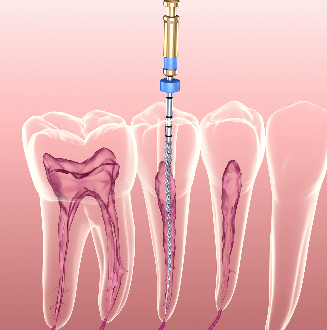 WHAT HAPPENS DURING A ROOT CANAL PART II Keith A Hoover April A